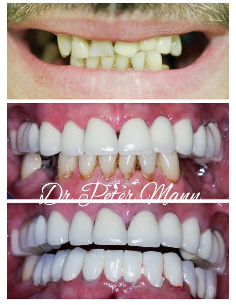 Smile MakeOver Before And After Photos | NYC Dentist